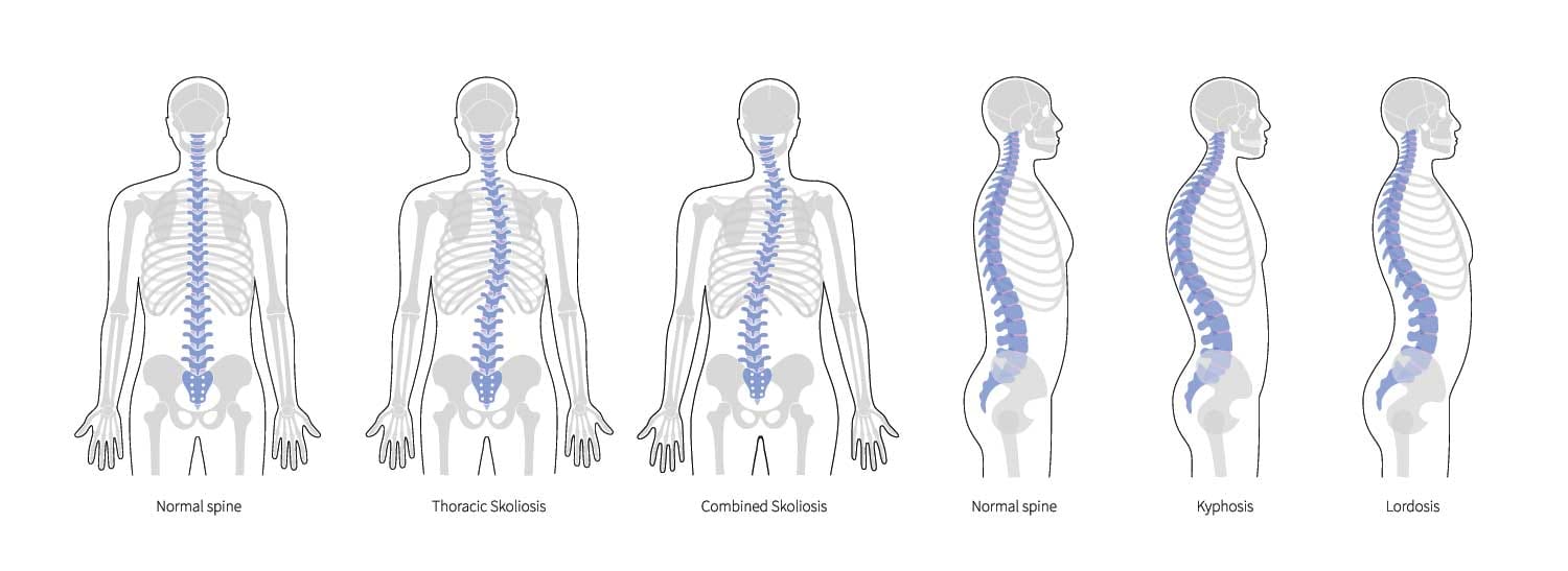Posture Correction | MHV Clinic | London