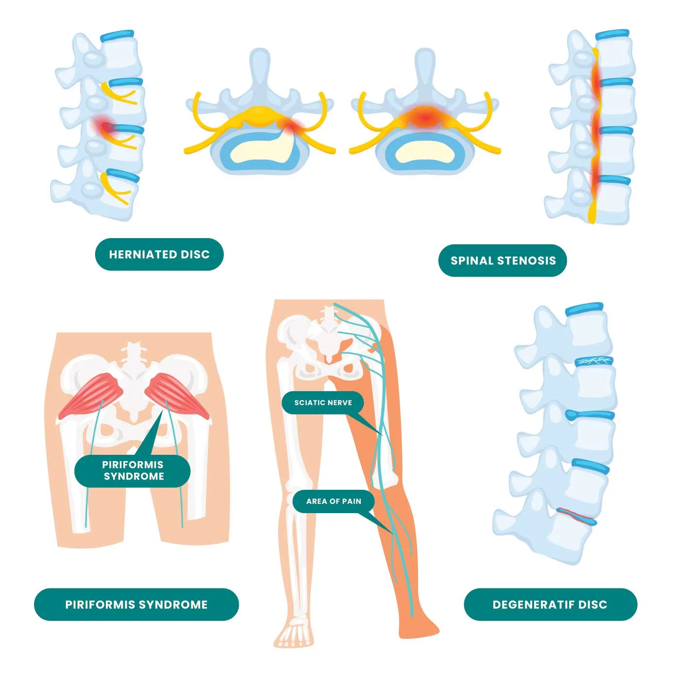 Piriformis Syndrome Treatment Sciatica Pain Treatment Immune System