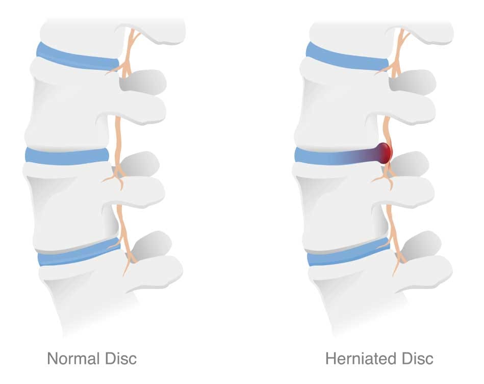 Types of Slipped Disc | Osteopath In London | MHV Clinic