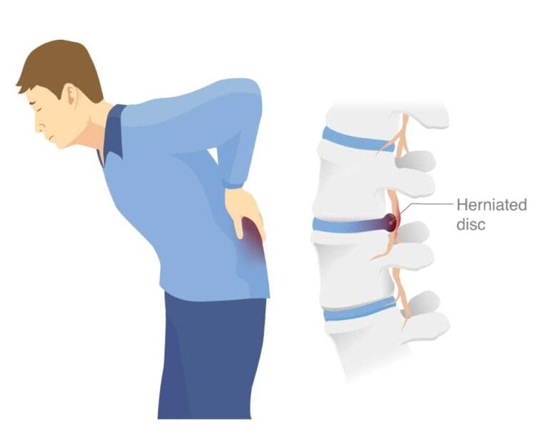 Types of Slipped Disc | Osteopath In London | MHV Clinic