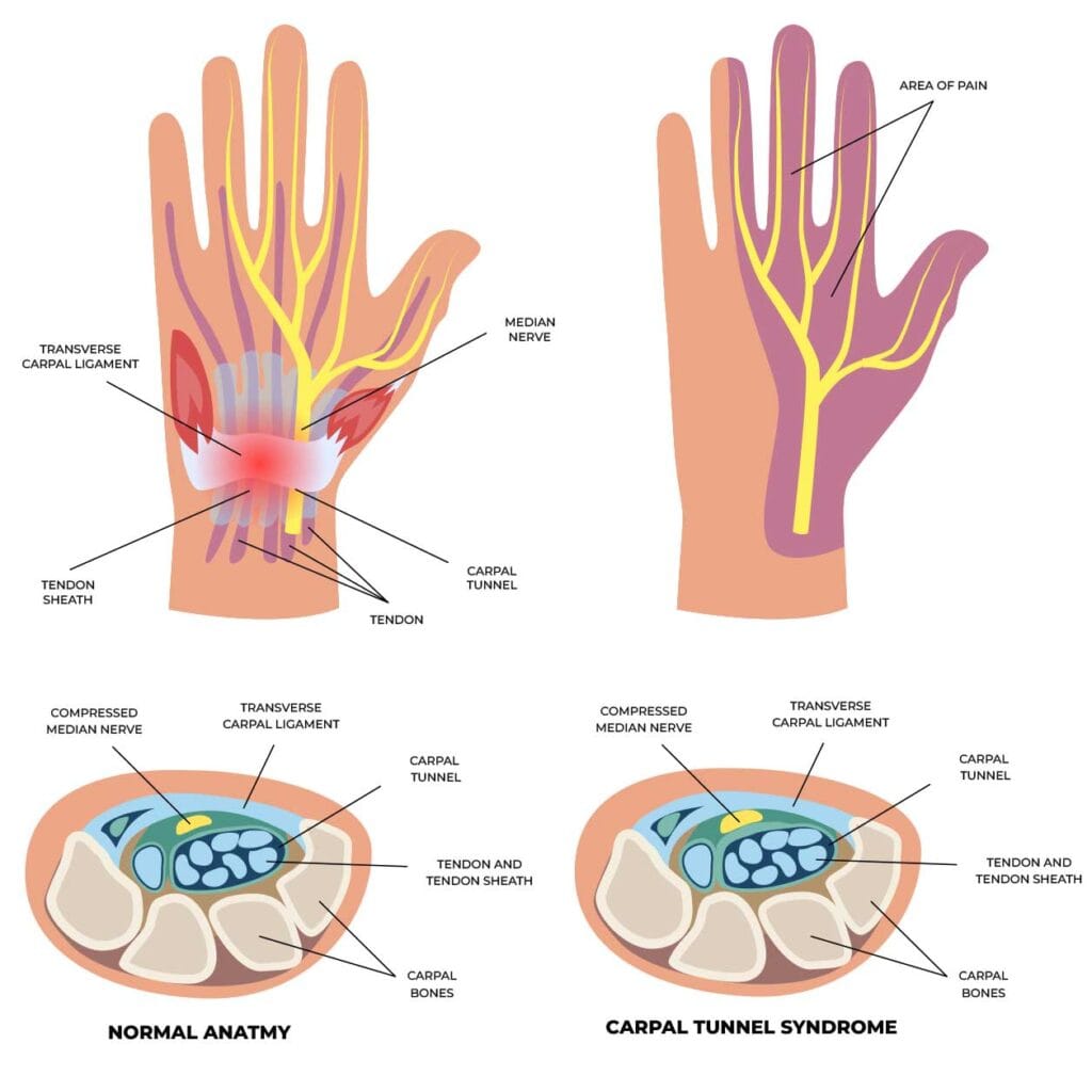 Types of Trapped Nerve | Osteopath In London | MHV Clinic