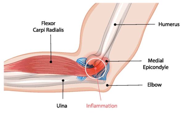Types of Elbow Injuries | Osteopath In London | MHV Clinic