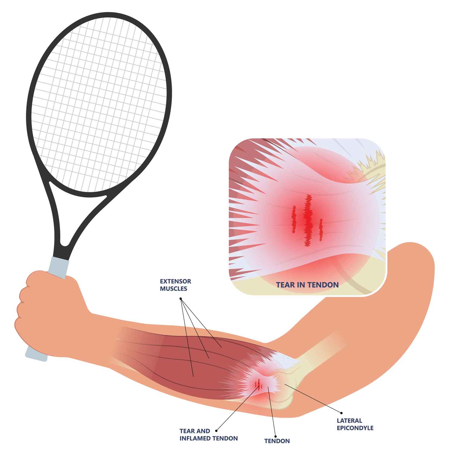 Types of Elbow Injuries | Osteopath In London | MHV Clinic