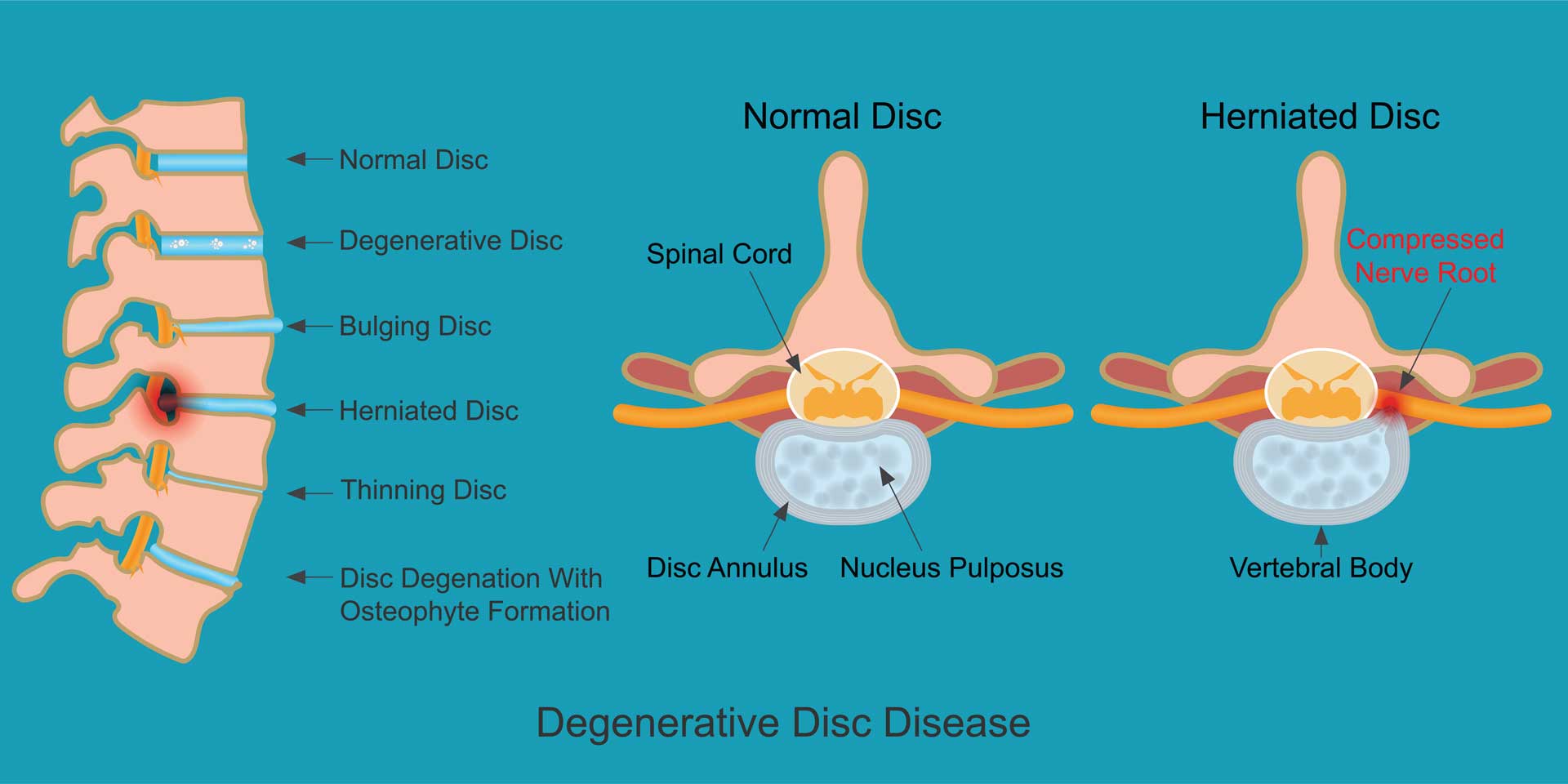 Can an Osteopath Help with a Herniation Disc? | MHV Clinic